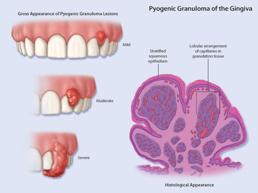 Pyogenic Granuloma Gingiva Histology