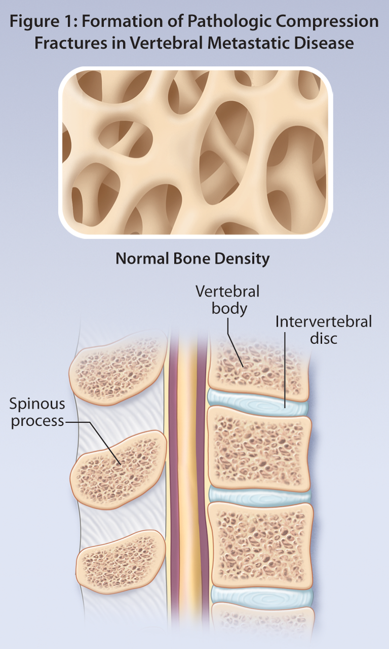Vertebral Metastatic Disease A Practice Guideline For The General Vertebral Metastatic Disease A Practice Guideline For The General