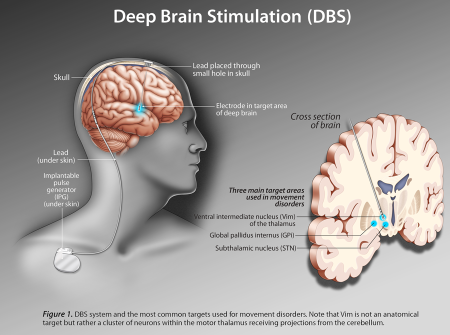 Deep Brain Stimulation HealthPlexus