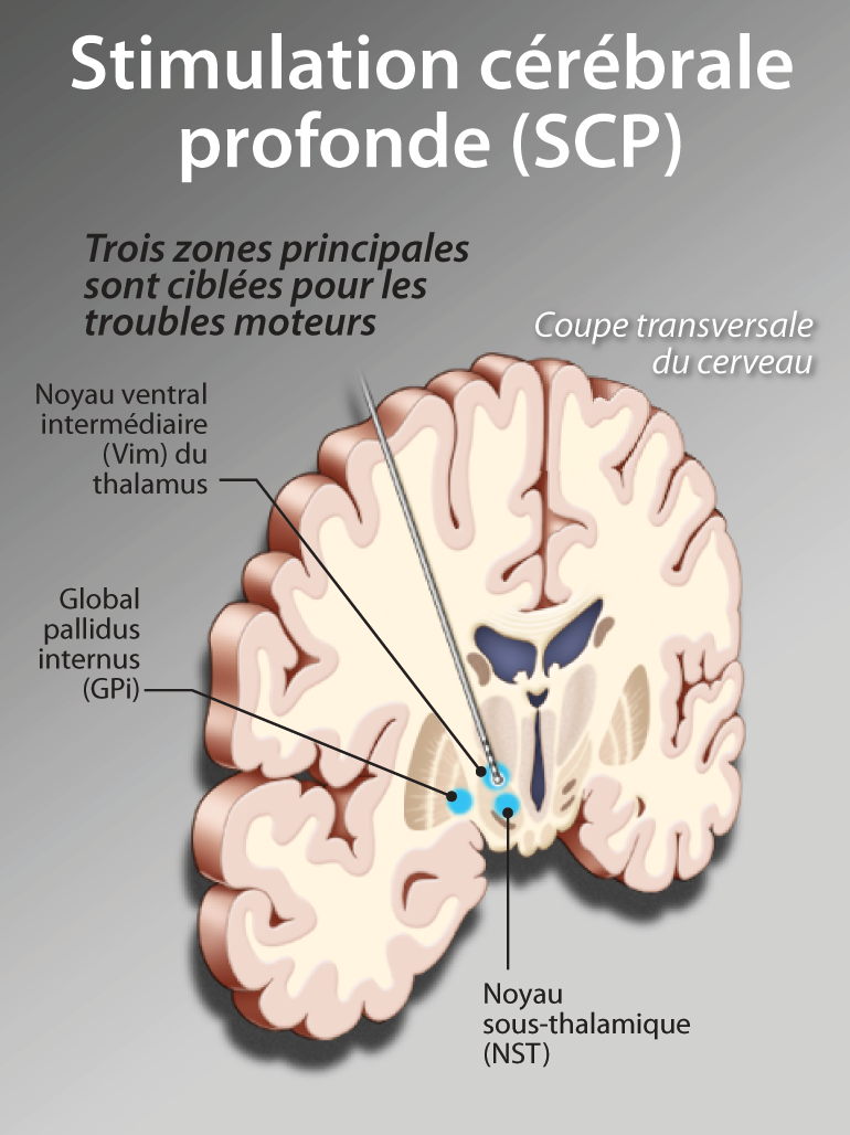 Stimulation C r brale Profonde HealthPlexus Stimulation C r brale Profonde HealthPlexus