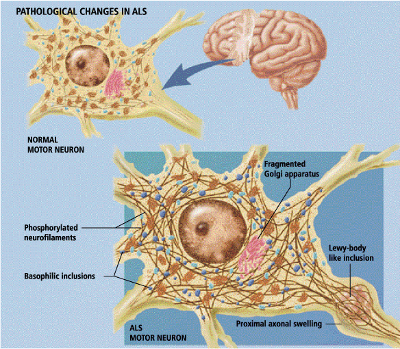 Lou Gehrigs Disease Als Symptoms Causes Treatment