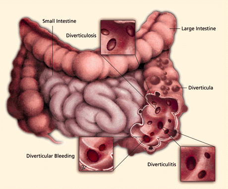 Diverticulosis Bleeding