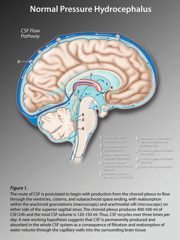 Normal Pressure Hydrocephalus HealthPlexus